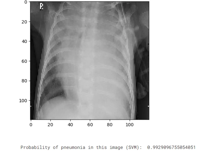 ML Beginner's Guide To Build Pneumonia Detection Model